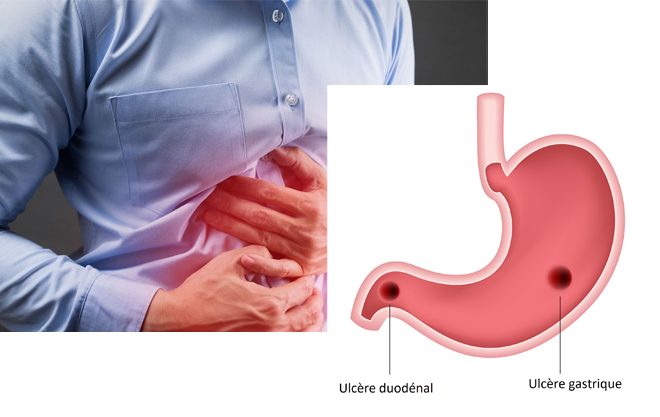 Quels sont les signes d'un ulcère à l'estomac ? Quels sont les aliments ...